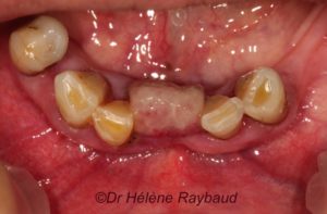 Epulis / Granulome pyogène – Dermatologie buccale