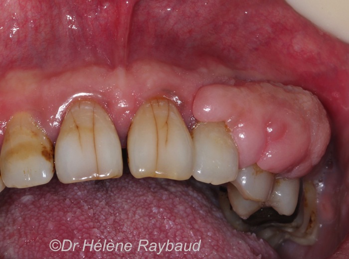 Epulis inflammatoire – Epulis fibreuse +/- ossifiante – Dermatologie ...