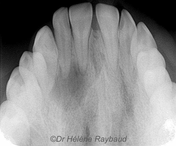 Abcès apical et parodontal / Fistule dentaire / Granulome fistulisé ...