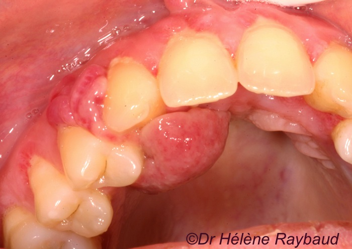 Epulis gravidique – Dermatologie buccale
