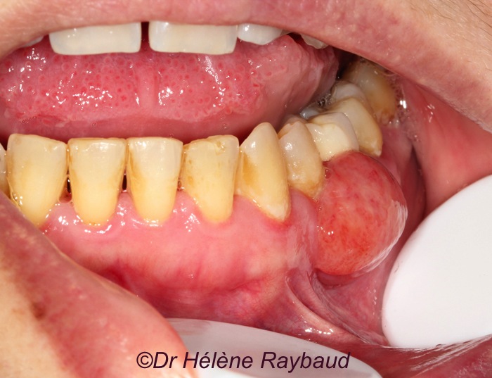 Epulis inflammatoire – Epulis fibreuse +/- ossifiante – Dermatologie ...