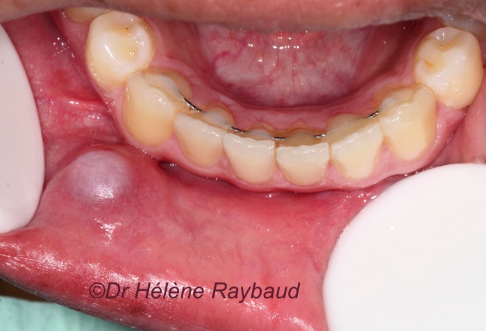 Mucocèle – Dermatologie buccale