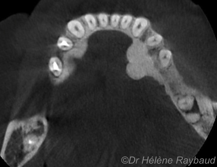 Exostoses et tori – Dermatologie buccale