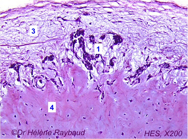 Adénome pléomorphe des glandes salivaires accessoires – Dermatologie ...