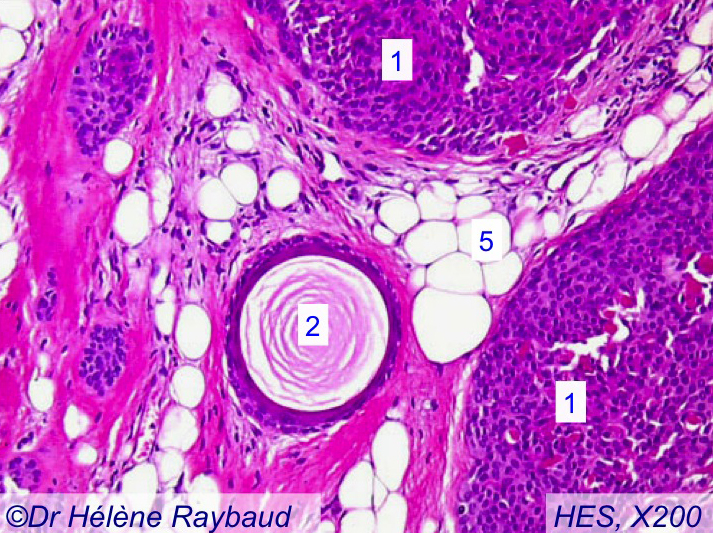 Adénome pléomorphe des glandes salivaires accessoires – Dermatologie ...