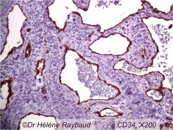 Angiome – Dermatologie buccale