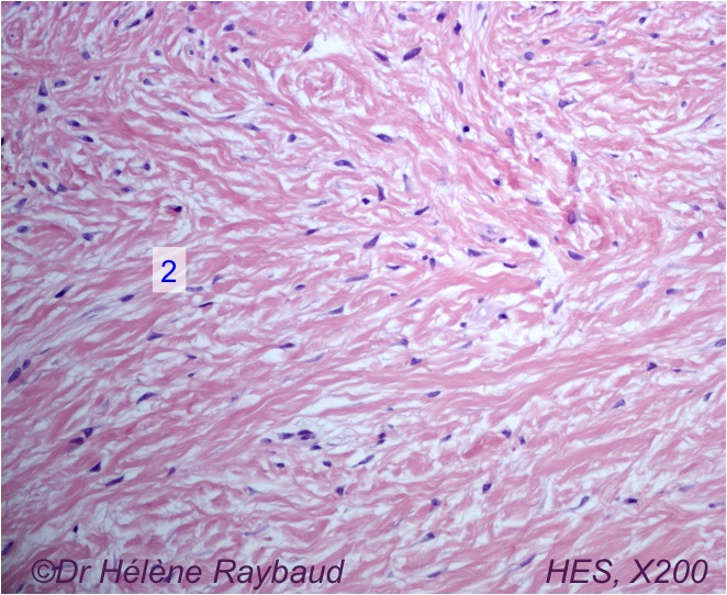 Fibrome vrai – Dermatologie buccale