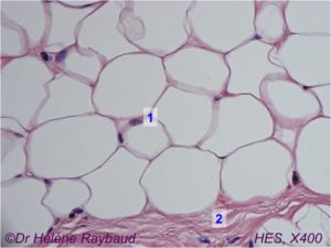Lipome – Dermatologie buccale