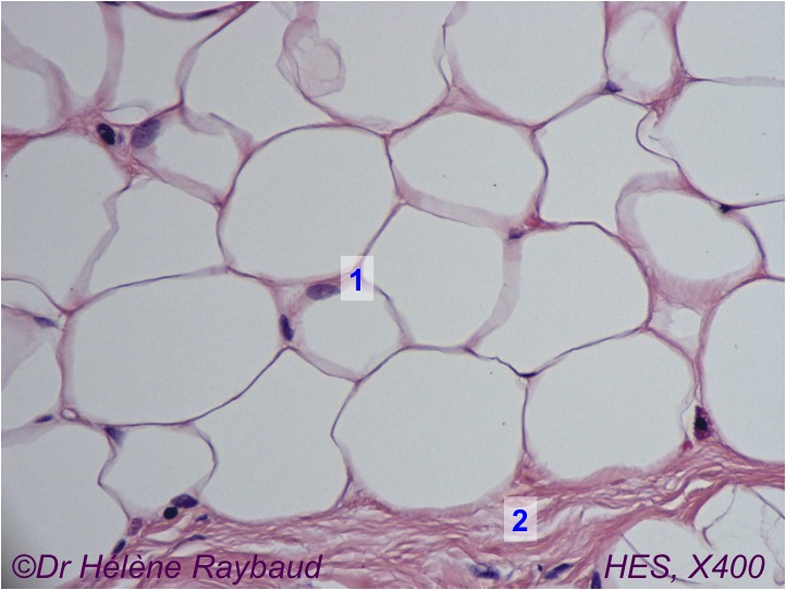 Lipome – Dermatologie buccale