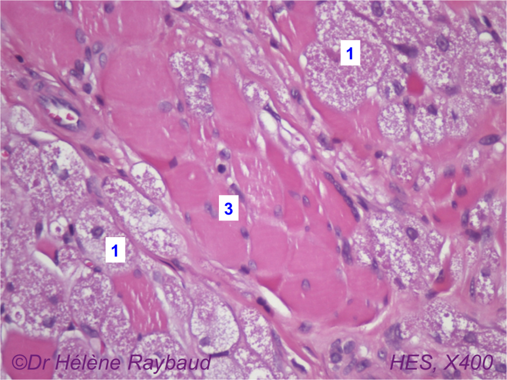 Tumeurs à cellules granuleuses – Dermatologie buccale