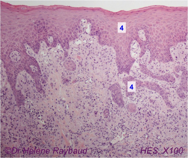 Tumeurs à cellules granuleuses – Dermatologie buccale