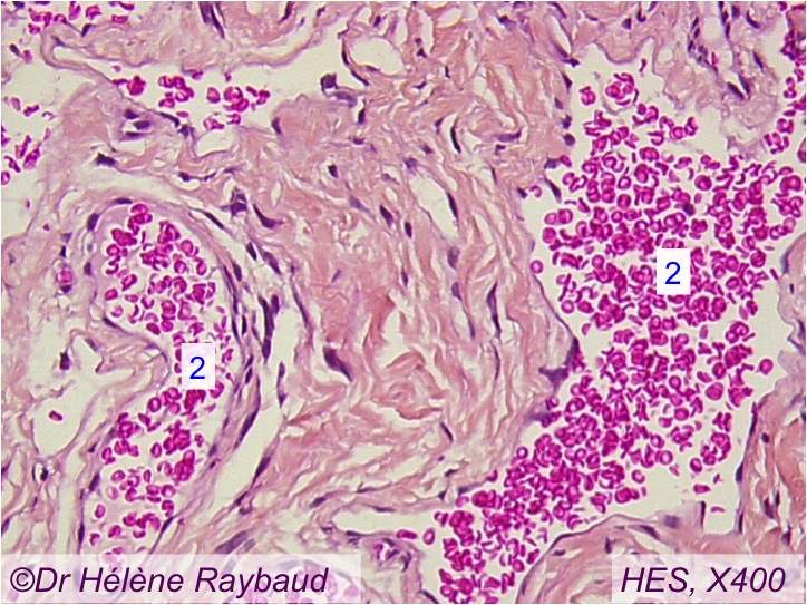 Angiome – Dermatologie buccale