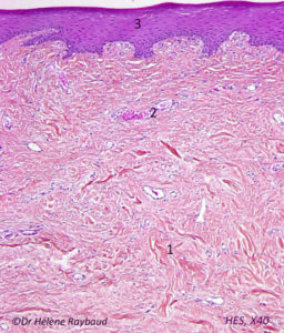 Cas 2 – Femme de 60 ans – Dermatologie buccale