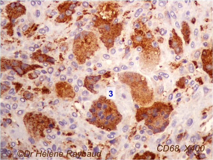 Epulis / Granulome périphérique à cellules géantes – Dermatologie buccale