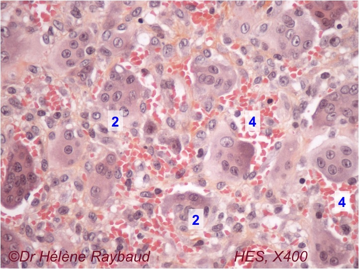 Epulis / Granulome périphérique à cellules géantes – Dermatologie buccale
