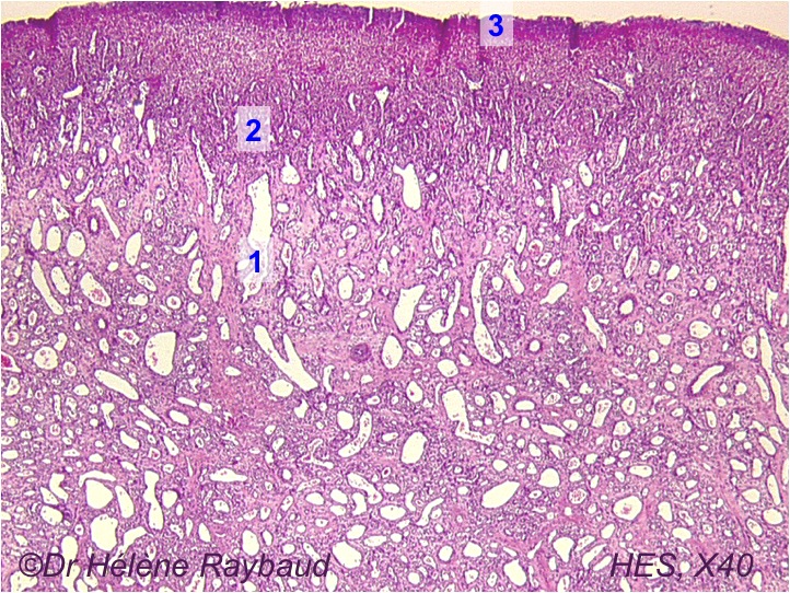 Epulis / Granulome pyogène – Dermatologie buccale