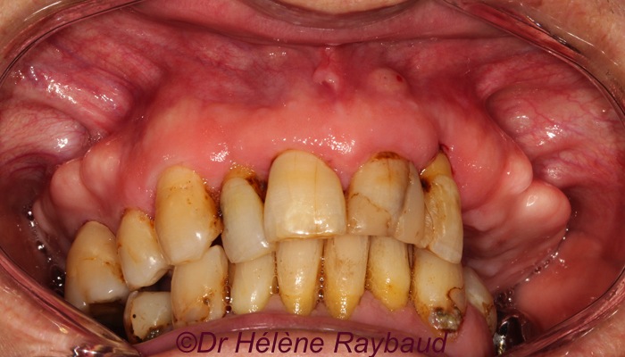 Exostoses et tori – Dermatologie buccale