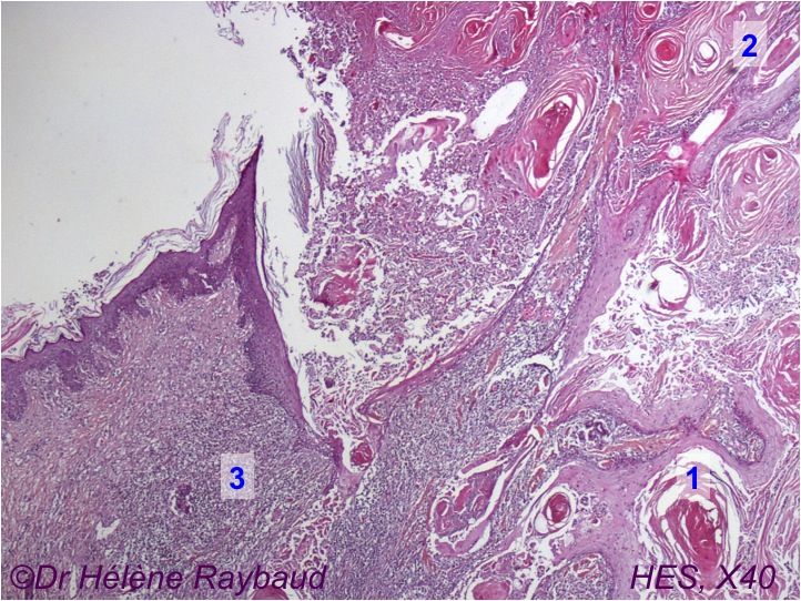 Kératoacanthome – Dermatologie buccale