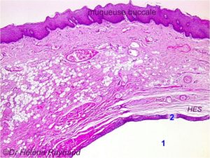 Kyste d’éruption dentaire – Dermatologie buccale