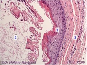 Kyste dermoïde – Dermatologie buccale