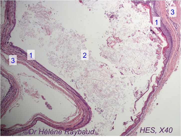 Kyste dermoïde – Dermatologie buccale