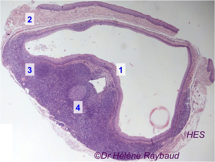 Kyste lympho-épithélial – Dermatologie buccale