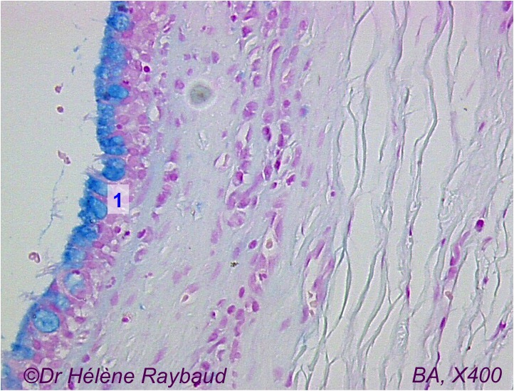 Kyste naso-labial – Dermatologie buccale