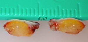 Lipome – Dermatologie buccale