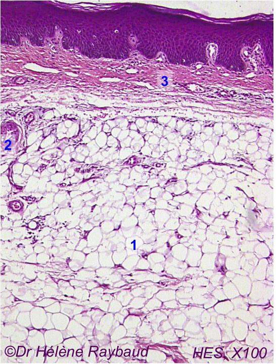 Lipome – Dermatologie buccale