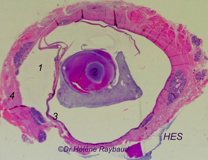 Mucocèle – Dermatologie buccale