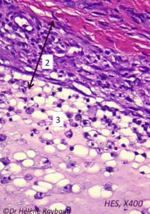 Cas 3 – Homme de 54 ans – Dermatologie buccale