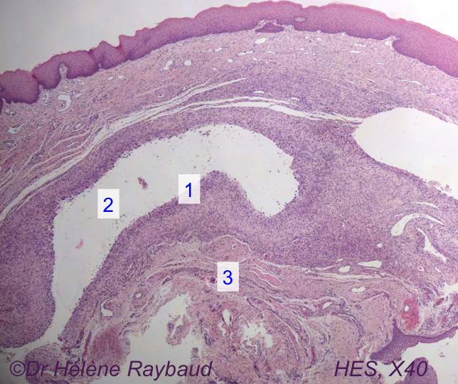 Mucocèle – Dermatologie buccale