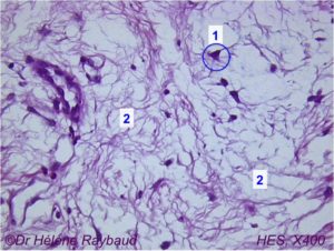 Myxome / Fibromyxome des tissus mous – Dermatologie buccale