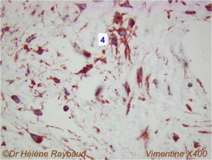 Myxome / Fibromyxome des tissus mous – Dermatologie buccale