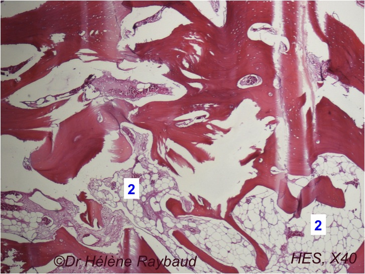 Exostoses et tori – Dermatologie buccale
