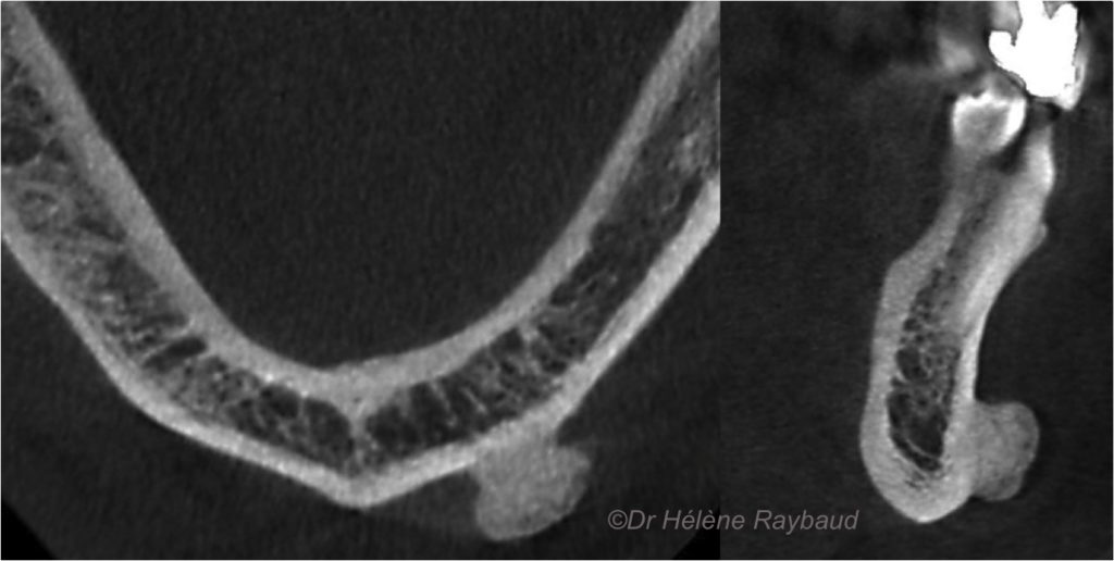 Exostoses et tori – Dermatologie buccale