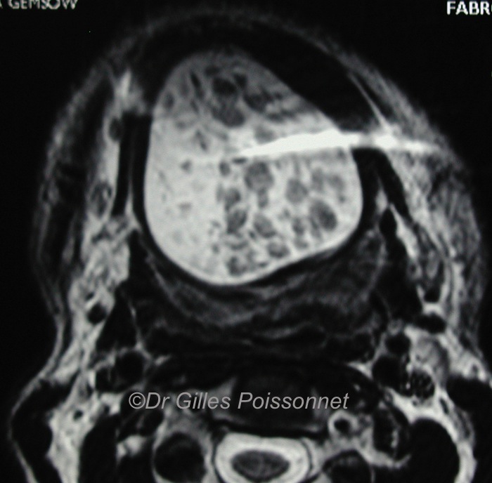 Kyste dermoïde – Dermatologie buccale